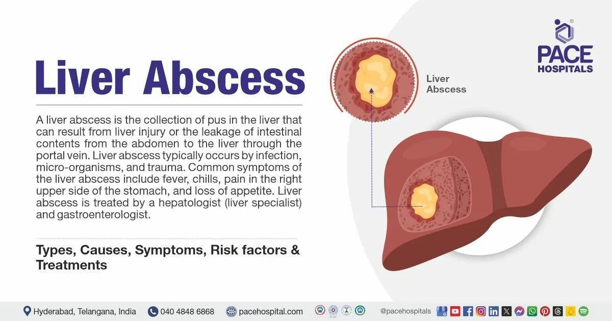 Liver Abscess A liver abscess is the collection of pus in the liver that..