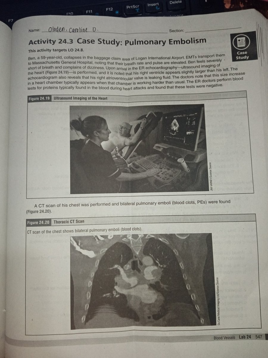 Activity 24.3 Case Study: Pulmonary Embolism This activity targets LO 24..