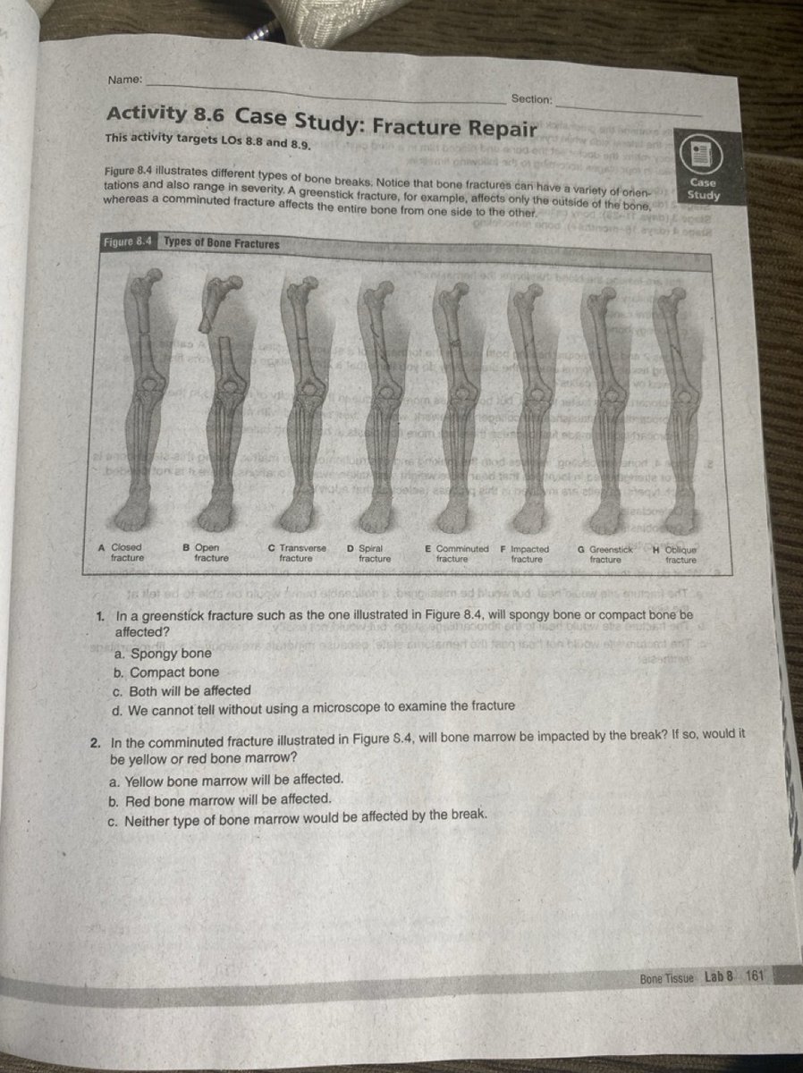 Activity 8.6 Case Study: Fracture Repair This activity targets LOs 8.8 a..