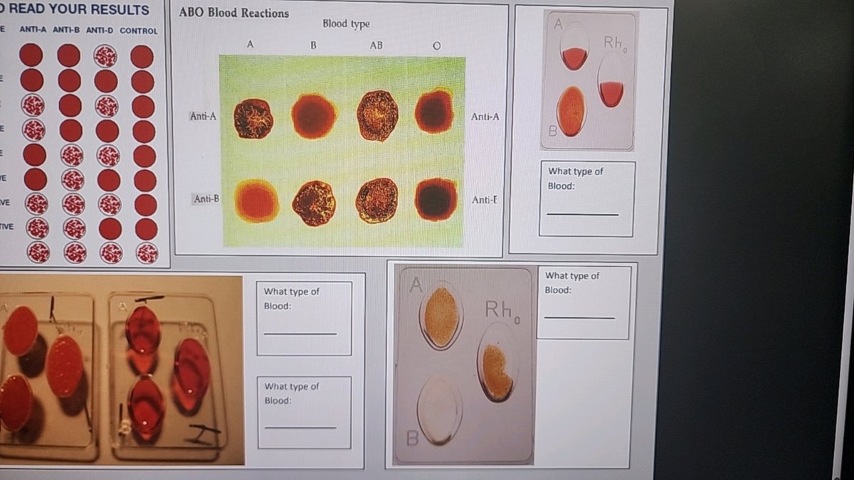 The image displays several diagrams related to blood typing, including AB..