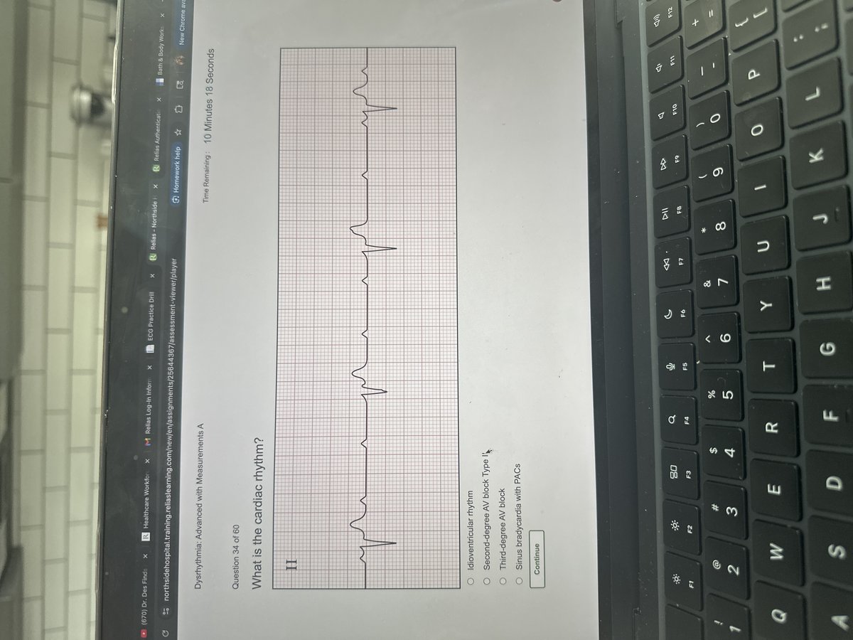 What is the cardiac rhythm? [Image of an ECG graph] Options: Idioventri..