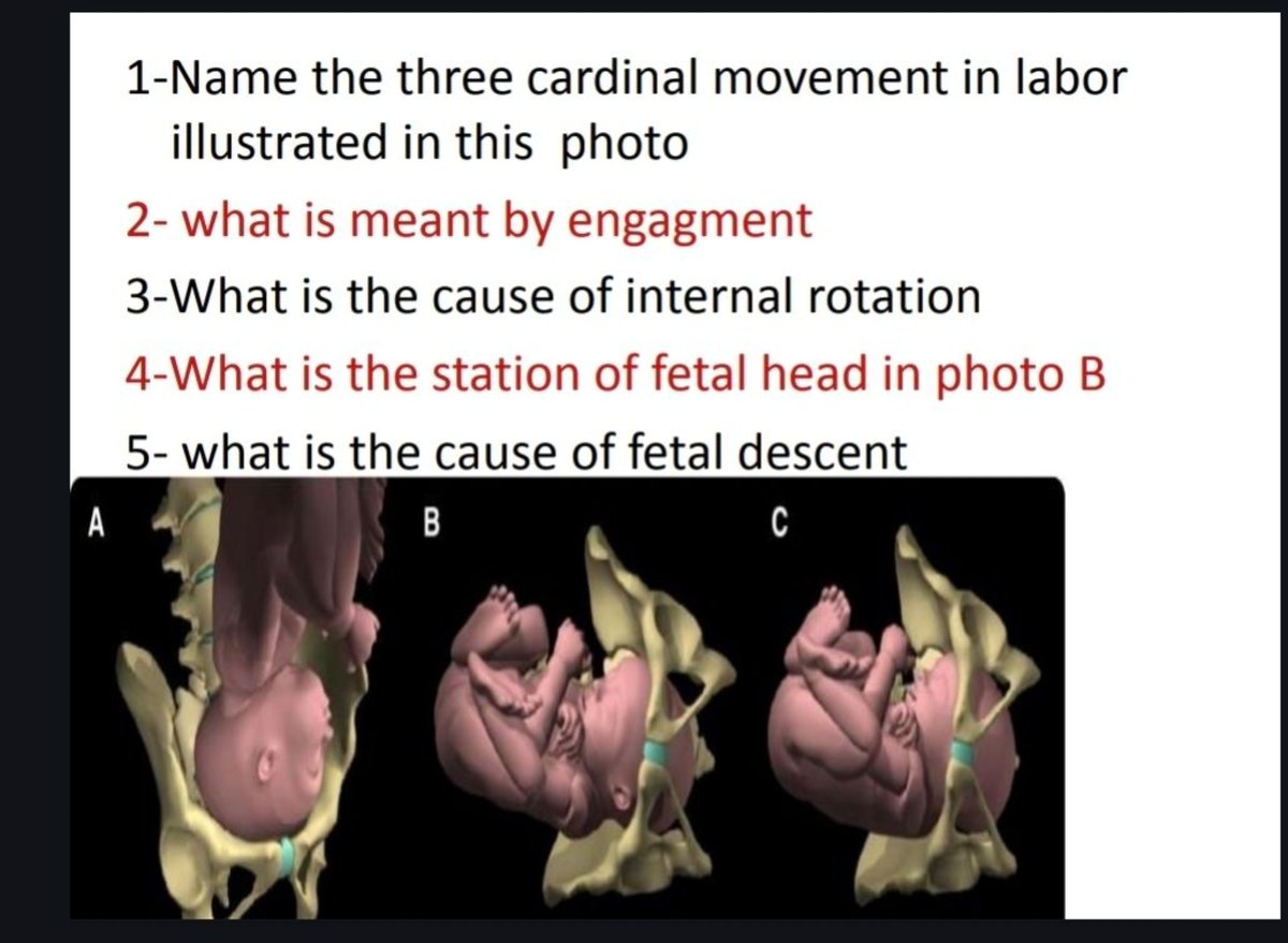 Name the three cardinal movements in labor illustrated in this photo. Wha..