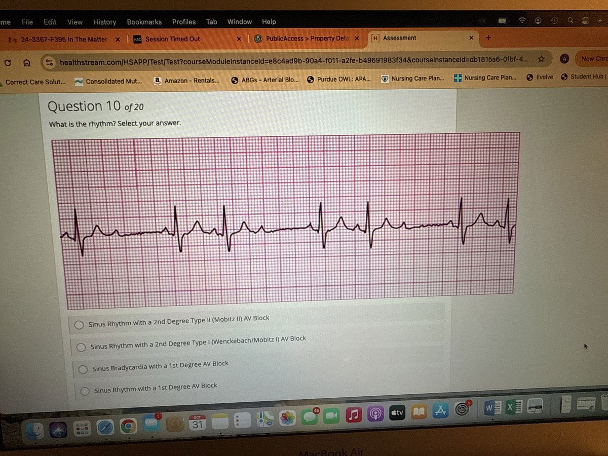 What is the rhythm? Select your answer. [Image of an ECG/EKG graph] Opt..
