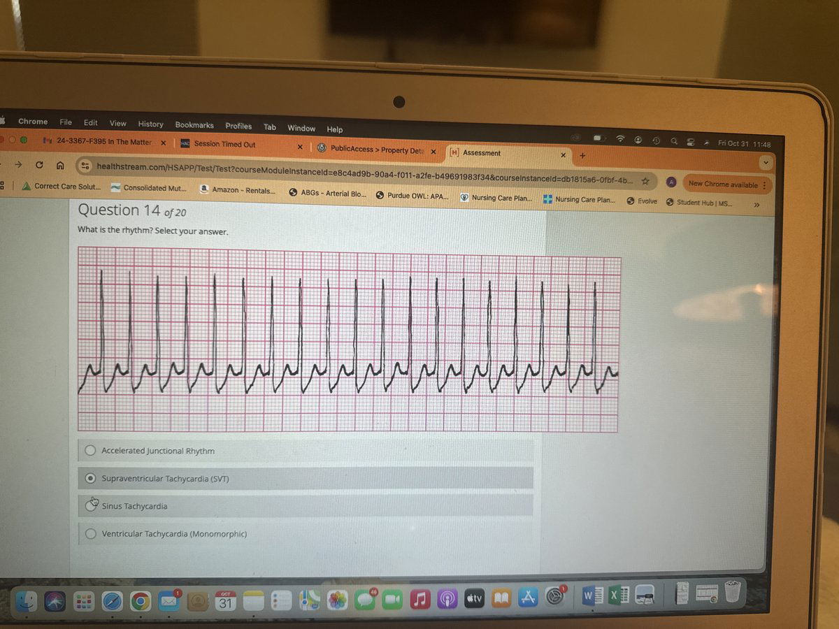 What is the rhythm? Select your answer. [Image of an ECG/EKG graph] Opt..