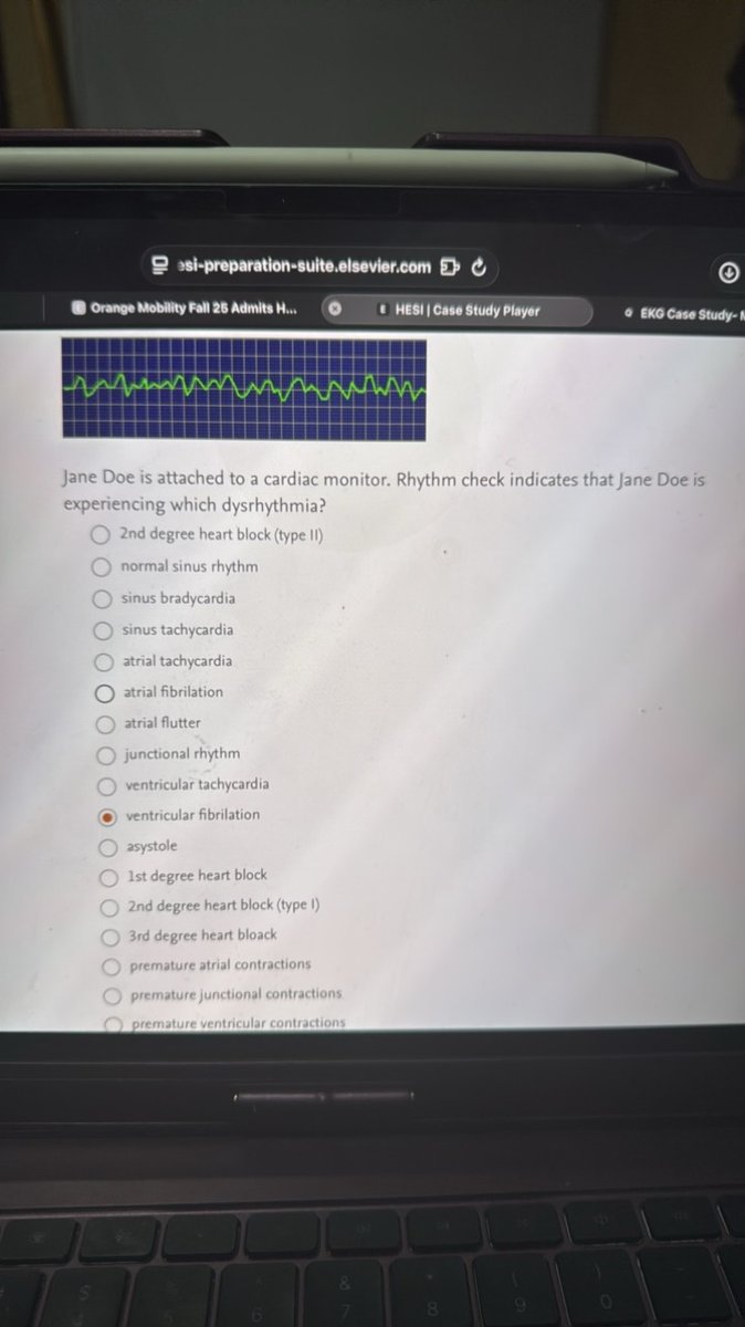 Jane Doe is attached to a cardiac monitor. Rhythm check indicates that Ja..