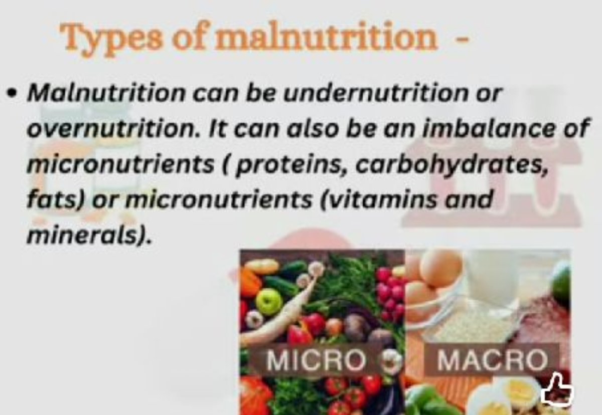 Types of malnutrition Malnutrition can be undernutrition or overnutritio..