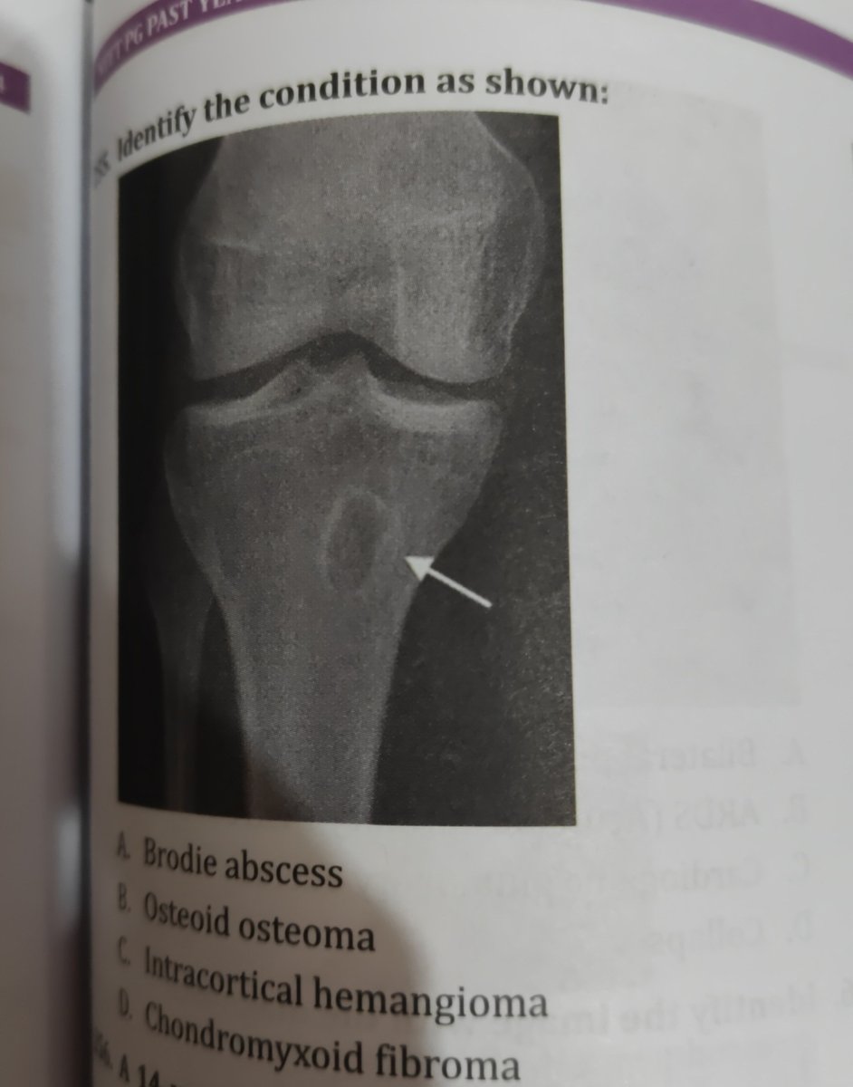 Identify the condition as shown: A. Brodie abscess B. Osteoid osteoma C...