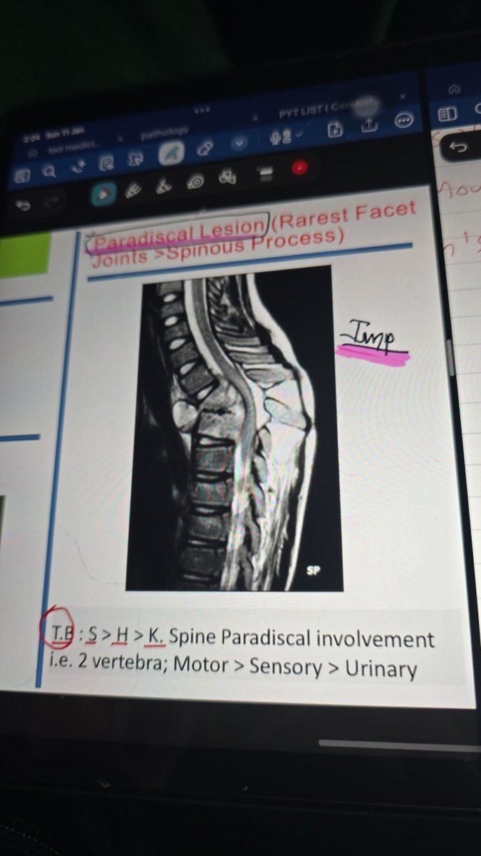 Paradiscal Lesion (Rarest Facet Joints > Spinous Process) T.B: S > H > K..