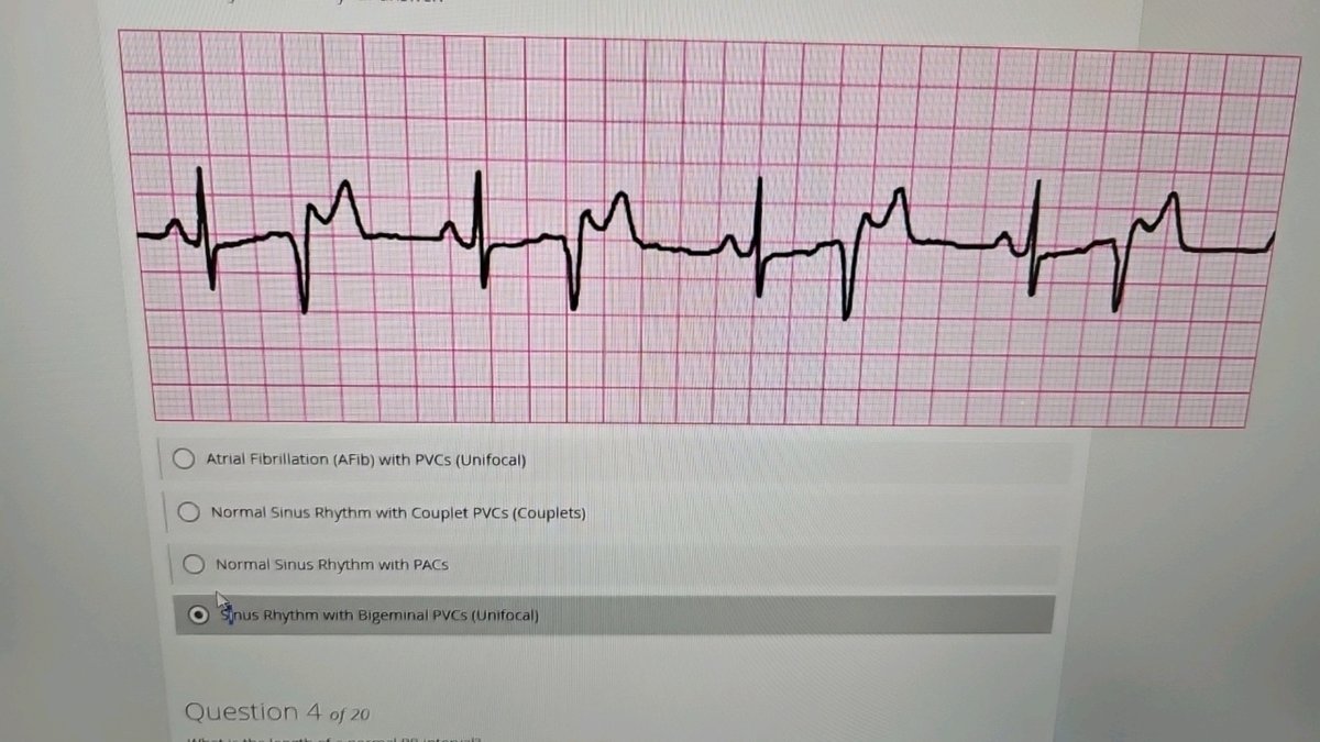 Analyze the provided ECG graph and select the correct interpretation from..