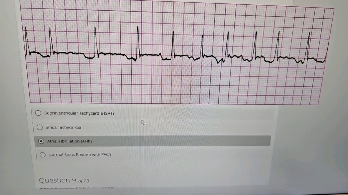 Analyze the provided ECG graph and identify the correct heart rhythm from..