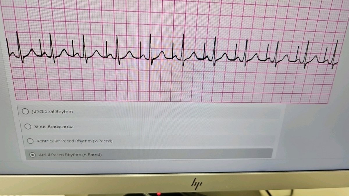 Identify the rhythm shown in the ECG graph: Junctional Rhythm Sinus Brad..