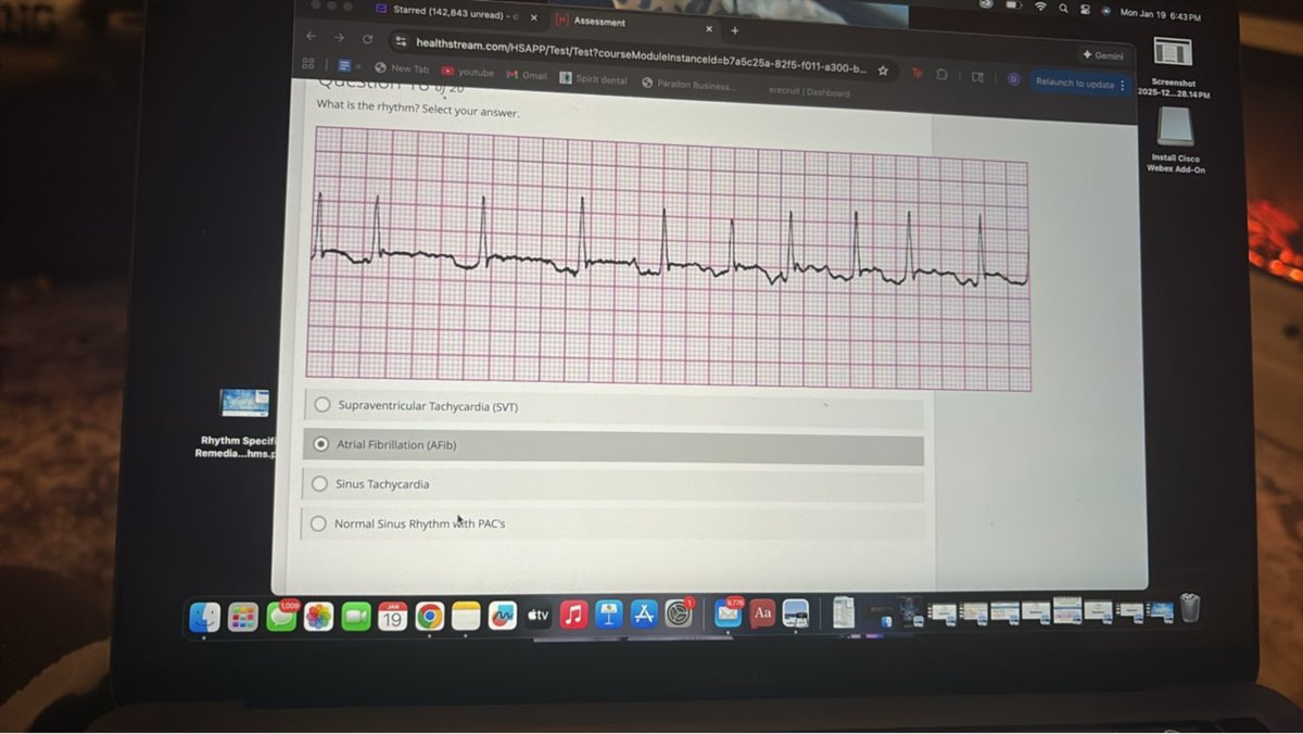 What is the rhythm? Select your answer. [Image of an ECG graph] Options..