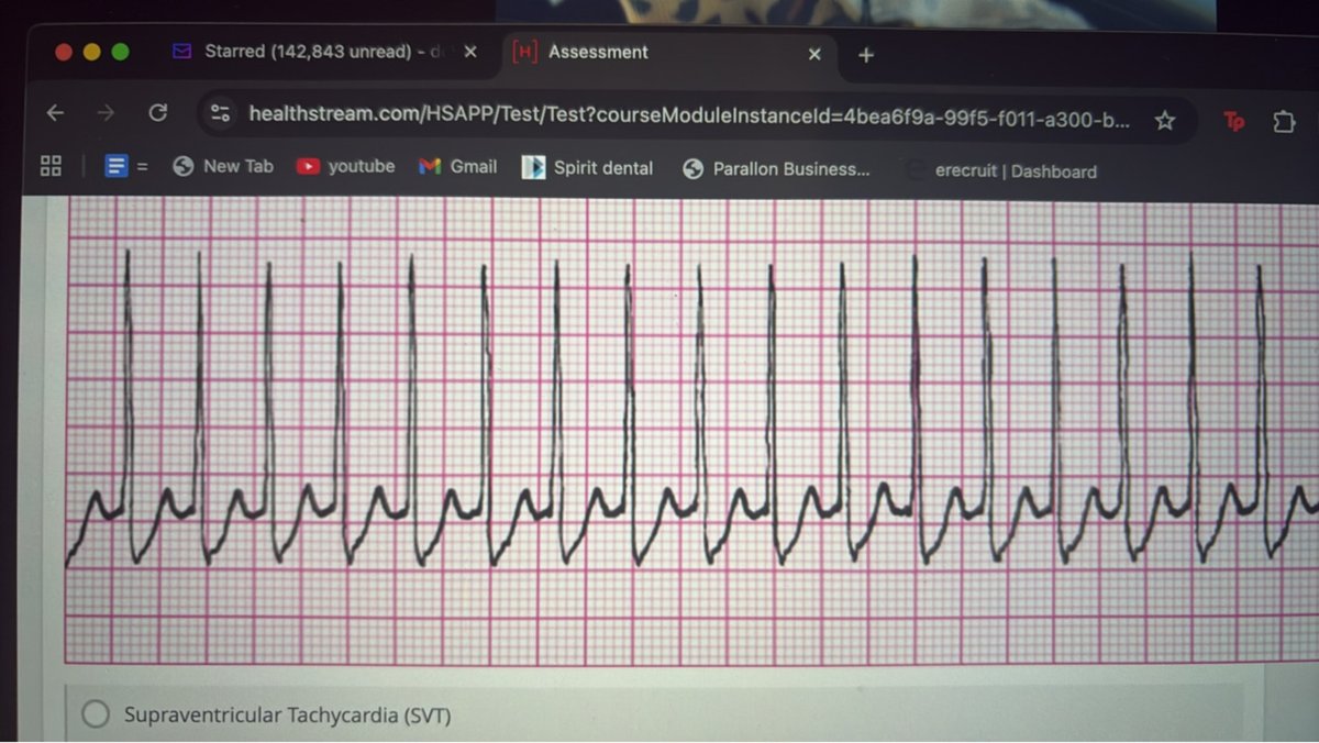 The image displays an electrocardiogram (ECG) tracing. Based on the visua..