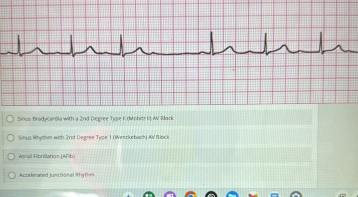 The image shows an ECG tracing. Based on the tracing, which of the follow..