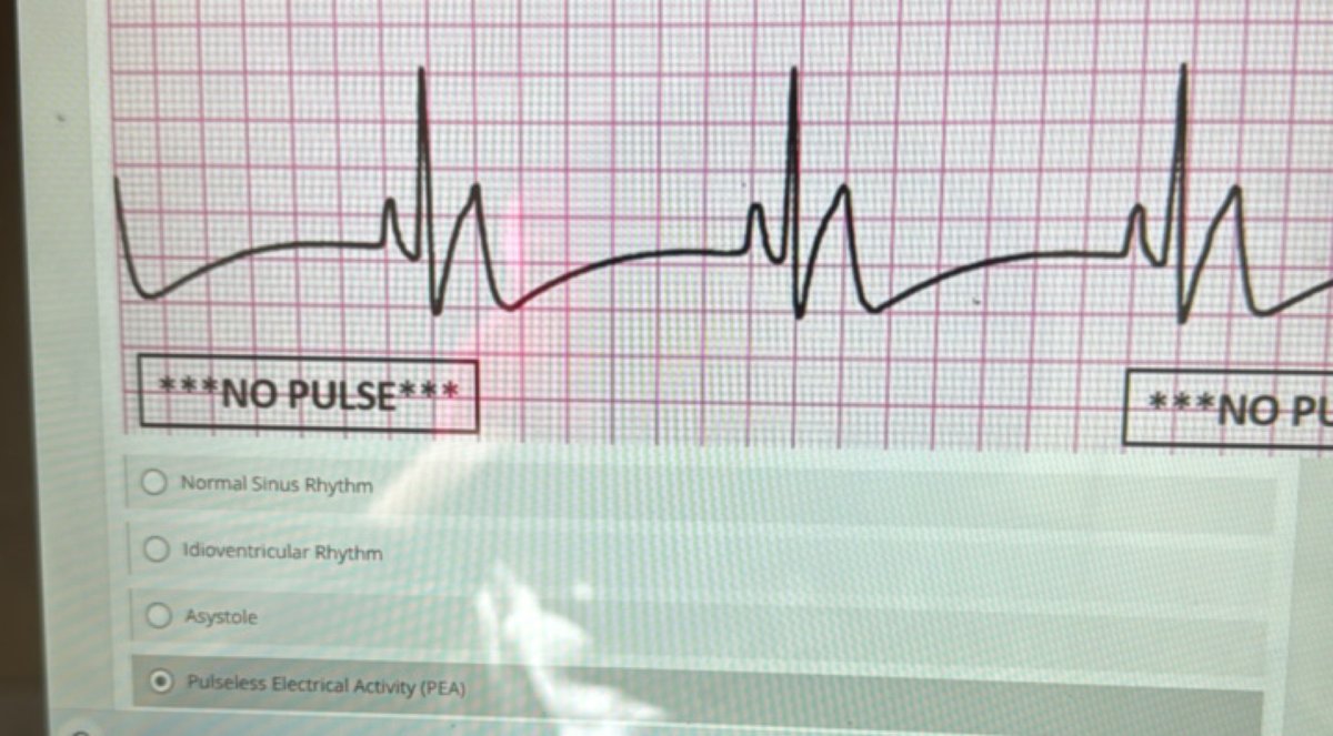 The image displays an ECG tracing with the text "NO PULSE" visible. Below..