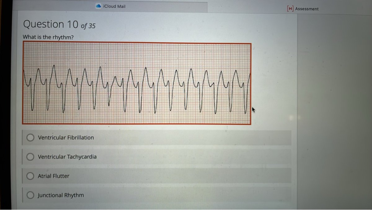 Question 10 of 35 What is the rhythm? [Image of an ECG graph] Ventricul..