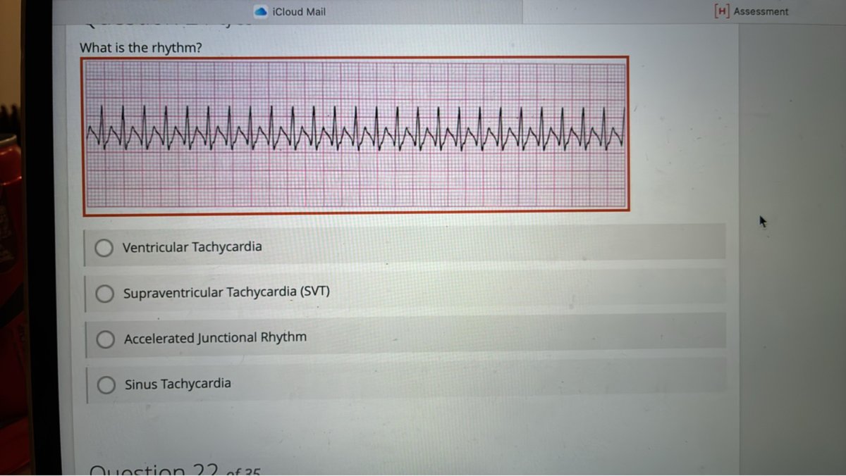 What is the rhythm? [Image of an ECG graph] A. Ventricular Tachycardia