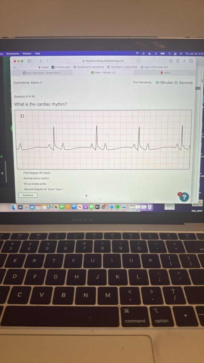 What is the cardiac rhythm? Options: First-degree AV block Normal sinus