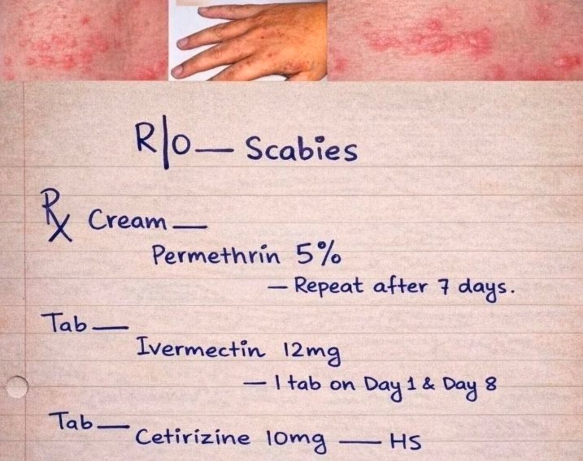 The image shows a medical prescription for Scabies. It includes: R/o - S..