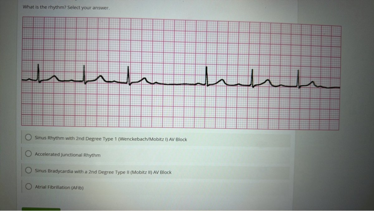 What is the rhythm? Select your answer. [Image of an ECG graph] Sinus R..